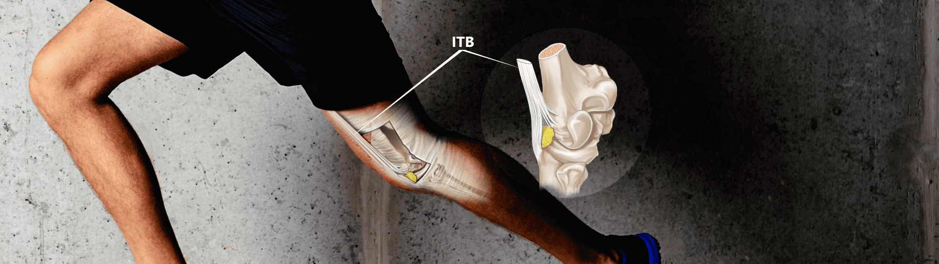 Treatment of ITB Syndrome at Our Clinic - New York Dynamic ...