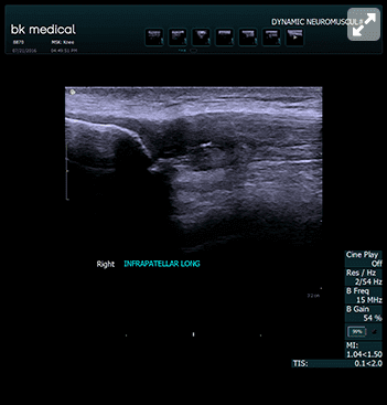 Patellar tendonitis - NYDNRehab.com