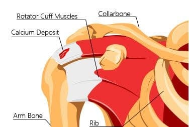 CALCIFIC TENDINITIS OF THE SHOULDER