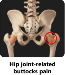 Causes, Diagnosis and Treatment of Buttocks Pain - NYDNRehab.com