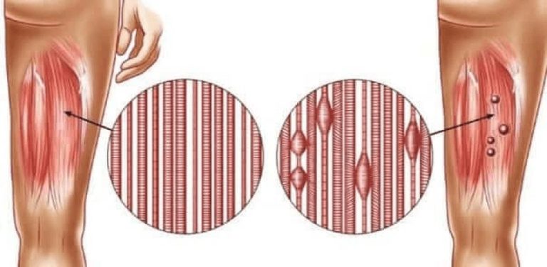 Extracorporeal Shockwave Therapy (ESWT / EPAT) in NYC - NYDNRehab