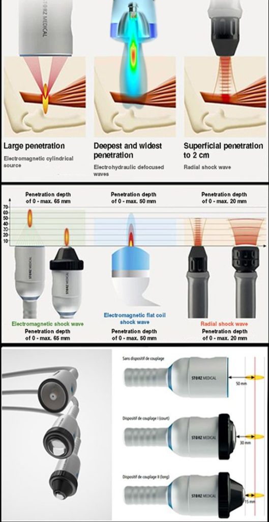 Extracorporeal Shockwave Therapy (ESWT / EPAT) in NYC - NYDNRehab
